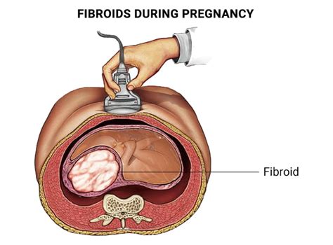 Fibroids During Pregnancy Vein And Endovascular Medical Care