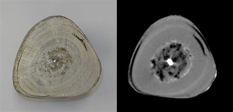 A Section Of The Removed Enterolith Left And The Ct Image Of The