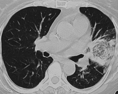 Axial Thoracic Ct Shows A Rounded Area Of Consolidation In The Lingula