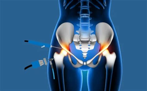 What Is Hip Arthroscopy Surgery Medisuggest