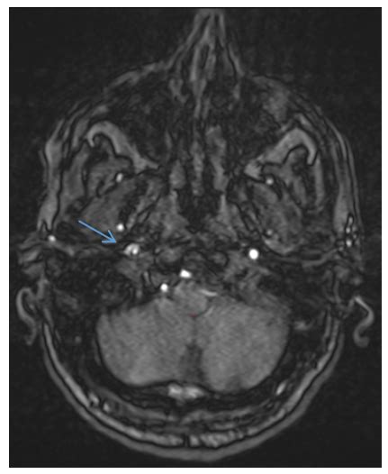 Crescent Sign In Ica Classical Case Of Ica Dissection