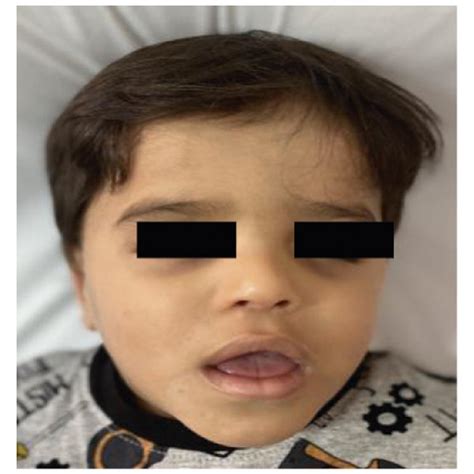 Patients Face And Tongue Showing Facial Dysmorphic Features
