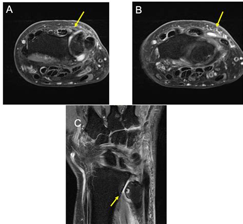 Extensor Tendon Rupture In Ulnar Impingement Syndrome A Case Report