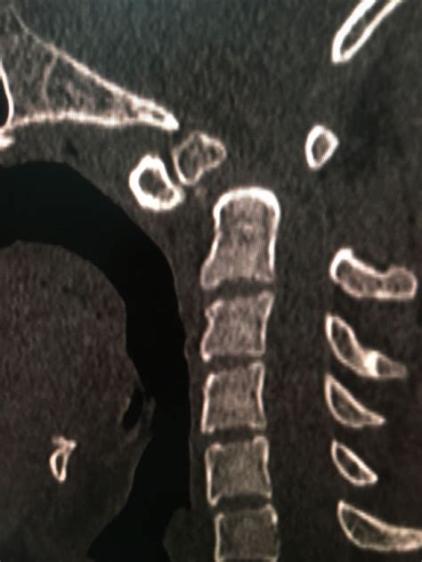 Os Odontoideum