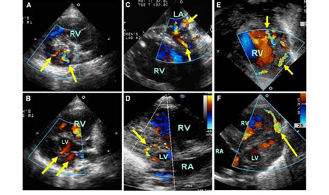 Color Doppler Flow Mapping Echocardiograms Of Ventriculocoronary Download Scientific Diagram
