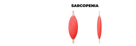 Perda De Força E Massa Muscular Entenda Como Sarcopenia Se Manifesta