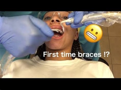 Getting Braces Vlog YouTube