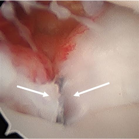 Arthroscopic Reduction Of Avulsion Fracture Demonstrating Anatomic Download Scientific Diagram