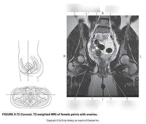 Coronal Female Pelvis With Ovaries Diagram Quizlet
