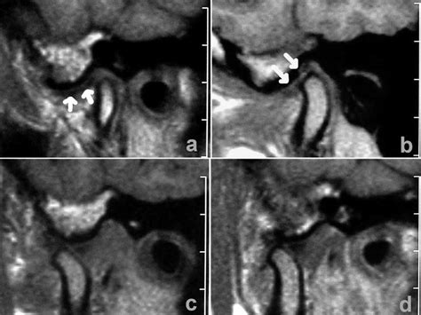 Magnetic Resonance Imaging 1 T Scanner Of Temporomandibular Joint