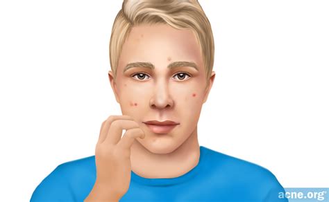 Skin Picking