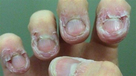 Calloused Skin Around Fingernails Captions Week