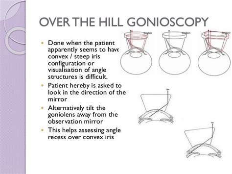 Gonioscopy
