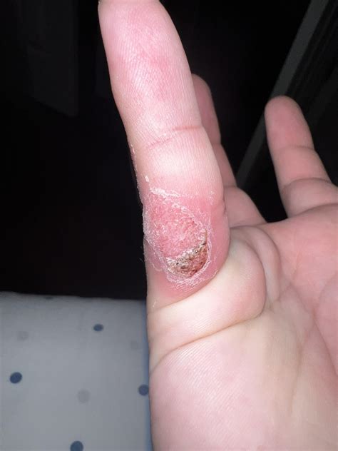 Wart Treated With 1 Injection Of Candida Wart Has Been Slowly Falling