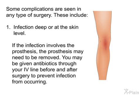 Knee Replacement Preventing Post Op Complications