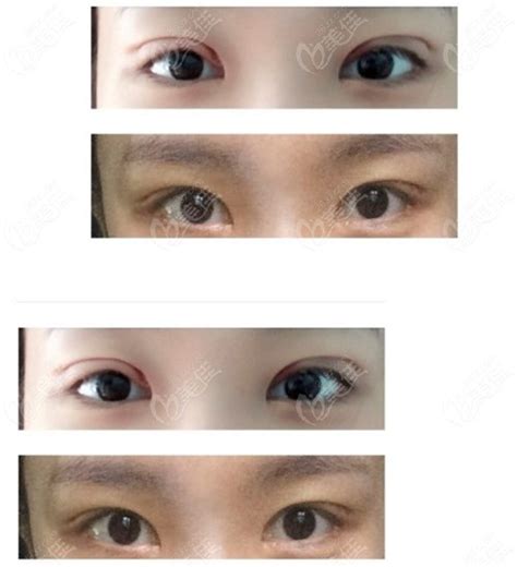 韩国大眼睛整形怎么样 医院做眼修复评价高且价格低 切开修复2万多 美佳社区