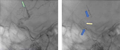 Intraoperative Images During The Positioning Of The Pipeline