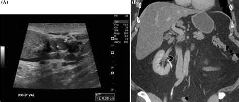 57 Year Old Male With Isolated Right Sided Varicocele And Normal Right