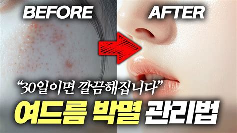 단 14일만에 좁쌀 여드름 피부 박멸하는 미용 관리법 13가지 Youtube