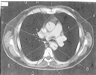 Sectional Anatomy Thorax Labeled Diagram Quizlet