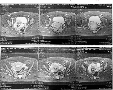 Figure 1 From Primary Uterine Cervix B Cell Lymphoma A Case Report And