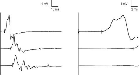 Polyneuropathy Clinical Tree