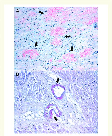 Distinct Patterns Of Amyloid Deposition In The Heart A Congo Red