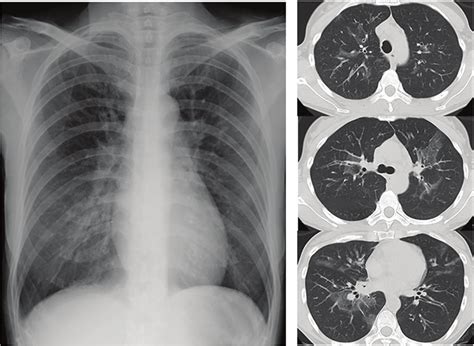 Chest X Ray And Computed Tomography Ct Scan On Admission Showing