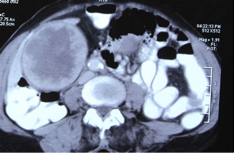 Pdf The Giant Resectable Carcinoma Of Gall Bladder 2020 Lovenish