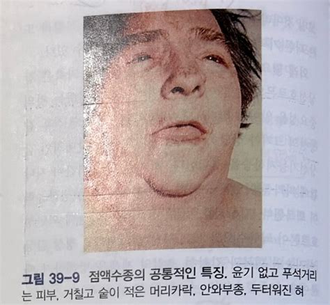 갑상선장애 [갑상선기능저하증] Hypothyroidism] 네이버 블로그