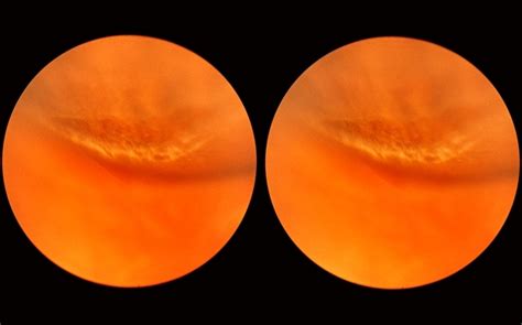 Lattice Lesion Retina Image Bank