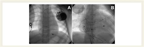 A Target Intracardiac Loop For RV Lead In Single Chamber Pacemaker
