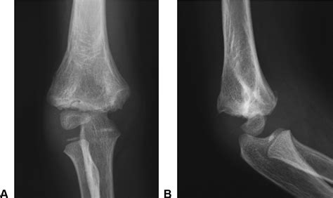 Isolated Coronal Shear Fracture Of The Nonossified Humeral Trochlea In