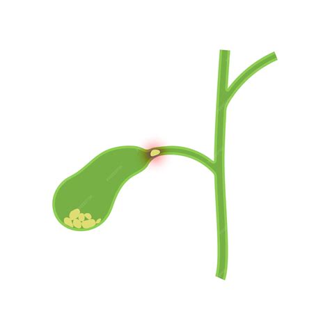 Premium Vector Gallbladder Disease Gallstones Bile Duct Obstructions