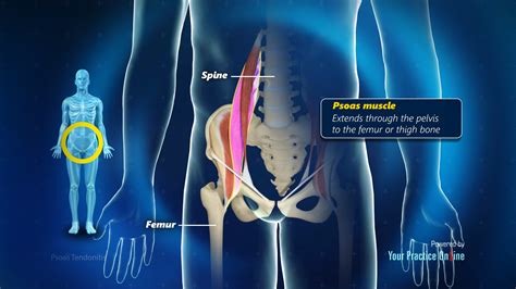 Psoas Tendonitis Video Medical Video Library