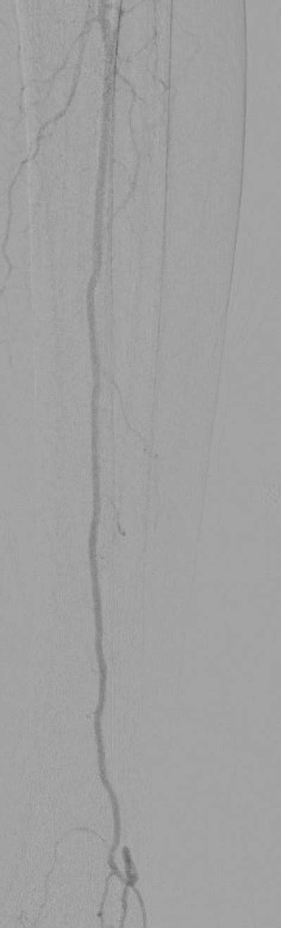 Completion Angiogram Demonstrating The Single Vessel Tibial Runoff Download Scientific Diagram