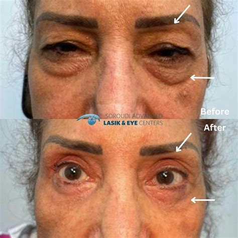 Blepharoplasty Eyelid Surgery Before And After Photos Soroudi Vision