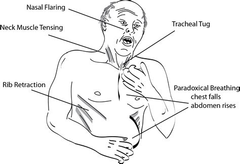 Recognizing Airway Obstruction May Save Your Patient S Lifethe Airway Jedi