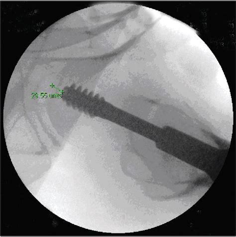 Figure 6 From A Review Of Tip Apex Distance In Dynamic Hip Screw Fixation Of Osteoporotic Hip