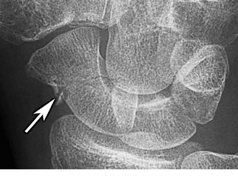 Figure 1 From Acute Scaphoid Fractures In Athletes Semantic Scholar
