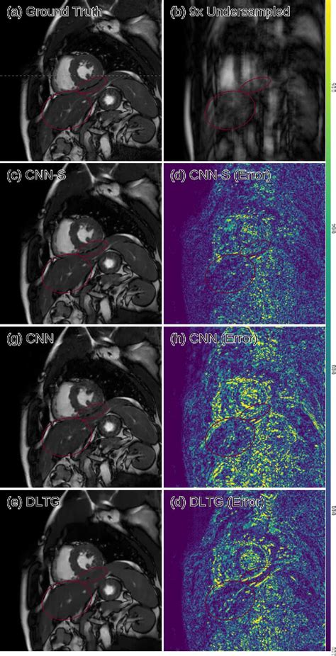 Figure 12 From A Deep Cascade Of Convolutional Neural Networks For Dynamic Mr Image
