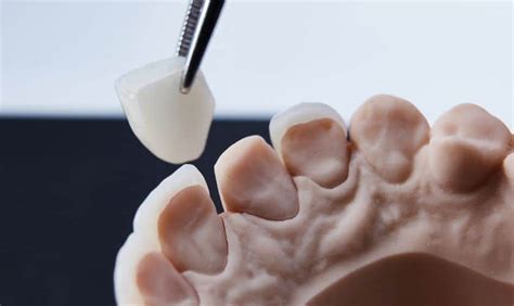 10 Best Tips For Dental Crown Procedures