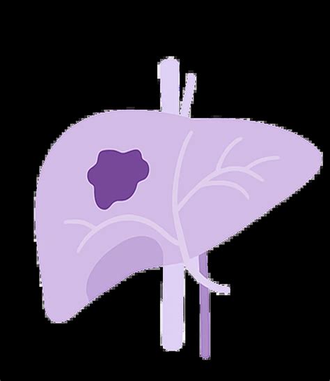 Tace Liver Cancer Treatment Minimally Invasive Chemoembolization
