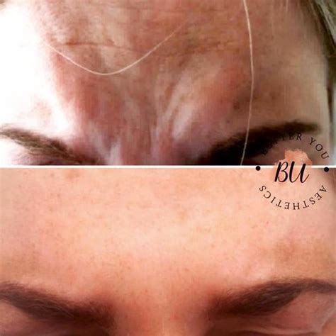 Botox For My 11s Facial Injections Info Prices Photos Reviews Qanda