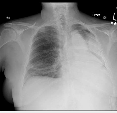 The Chest X Ray Reveals A Large Left Sided Pneumothorax And Total Left