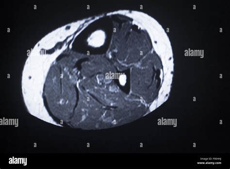 Mri Magnetic Resonance Imaging Medical Scan Test Results Showing