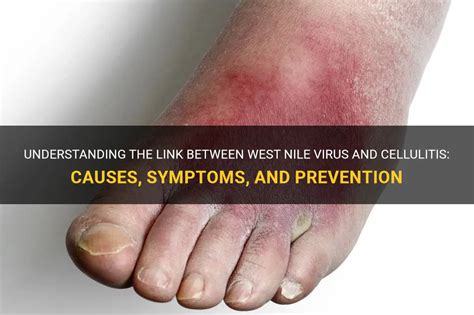 Understanding The Link Between West Nile Virus And Cellulitis Causes