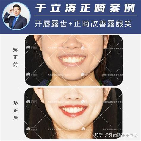 太原牙齿矫正开唇露齿，正畸多样性方案解决露龈笑 知乎