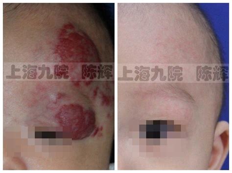 血管瘤治疗方法的优劣和选择（多图详解） 知乎