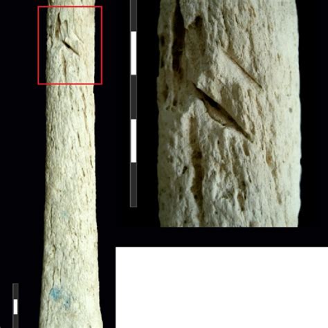 Photo Of The Internal Hemipelvectomy Surgery Showing The Preservation Download Scientific